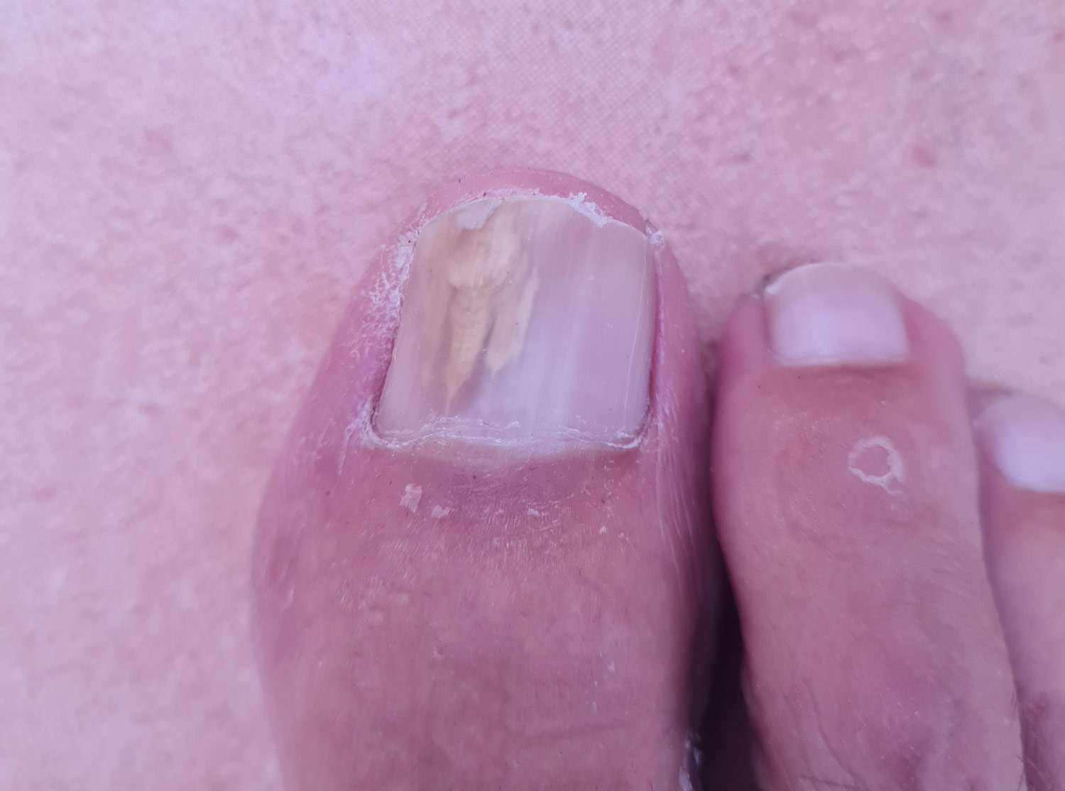 Hongos en las uñas del pie: causas, síntomas y tratamientos