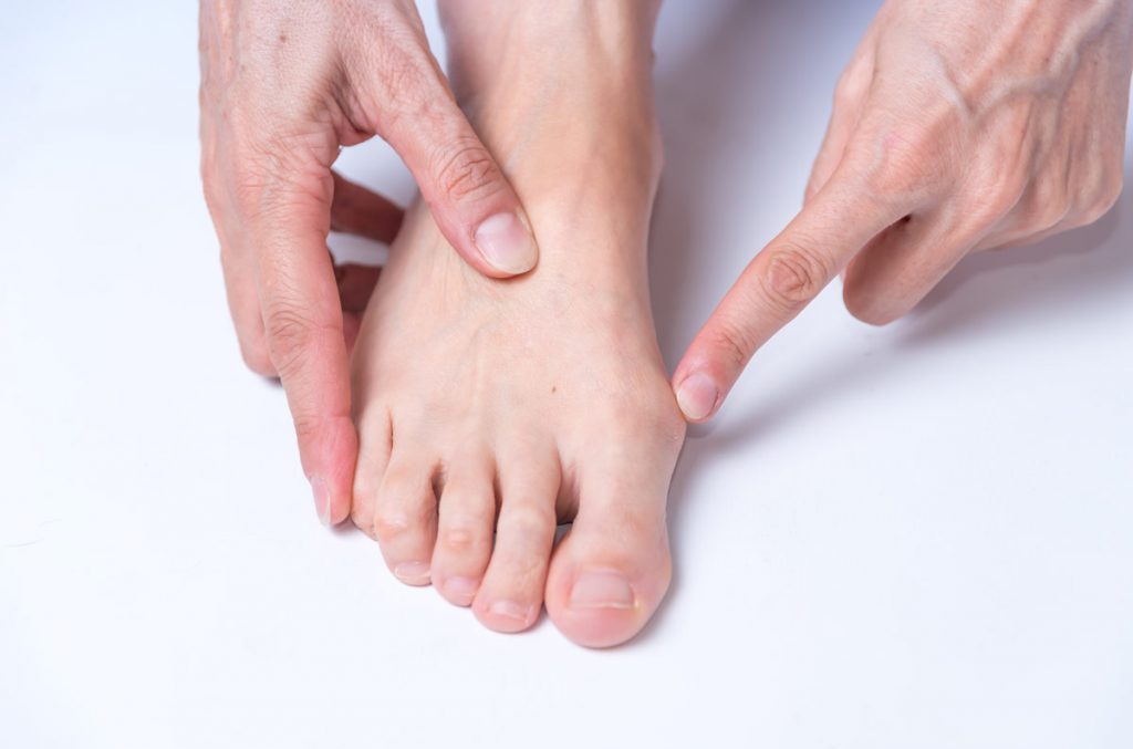Juanetes (Hallux Valgus): Qué son, causas, síntomas y tratamiento ...