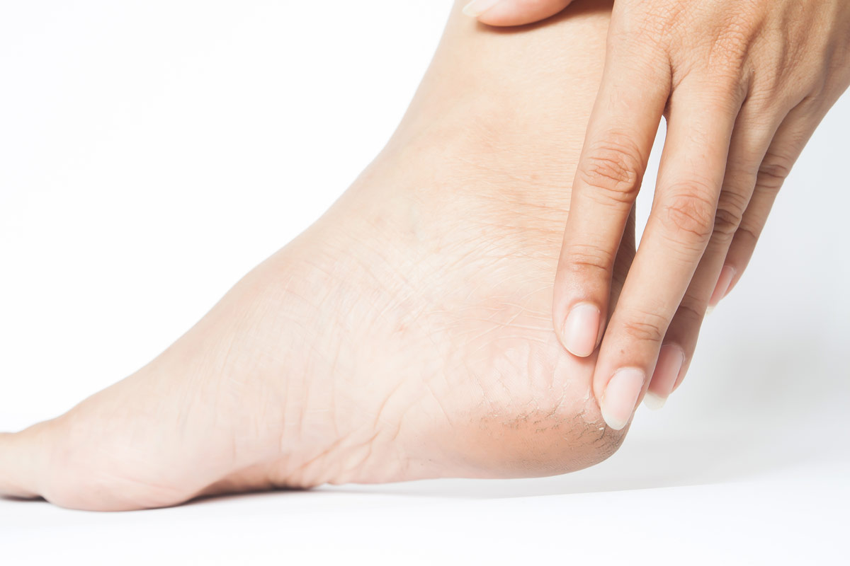 Talones agrietados: causas, tratamiento y prevención